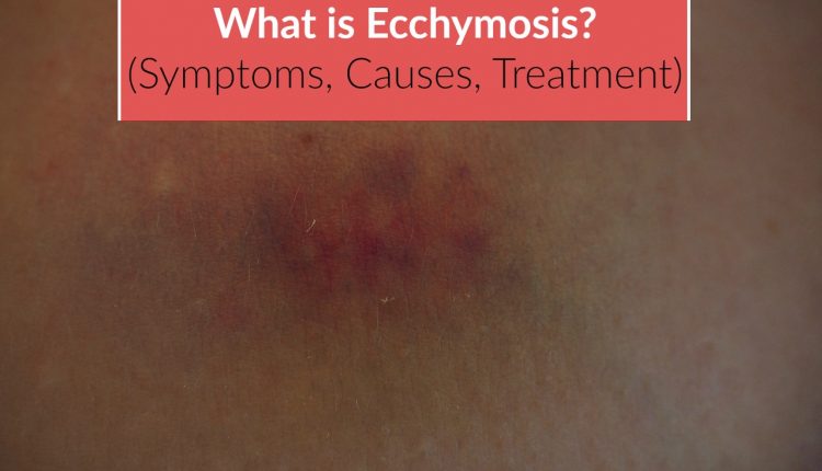 Periorbital Ecchymosis Pictures Symptoms Causes Treatment