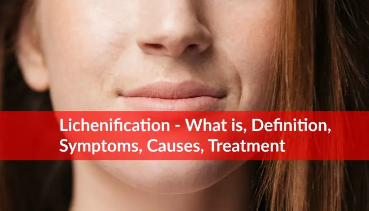 Lichenification - What is, Definition, Causes, Treatment...