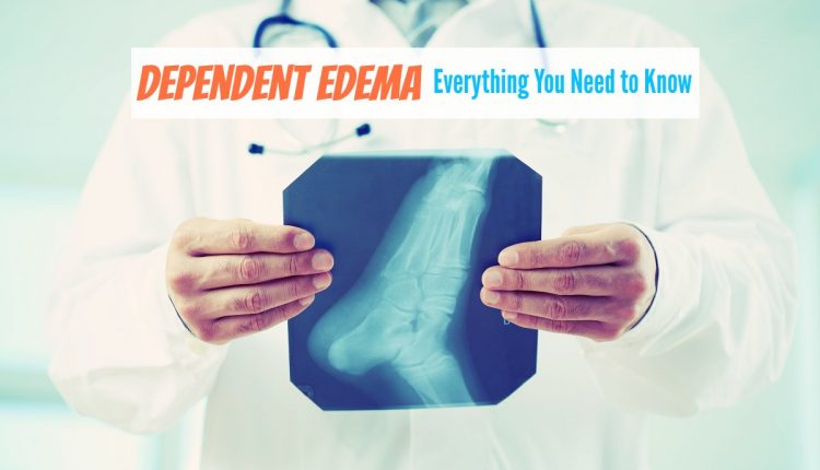 Dependent Edema: Everything You Need to Know - The Healthy Apron